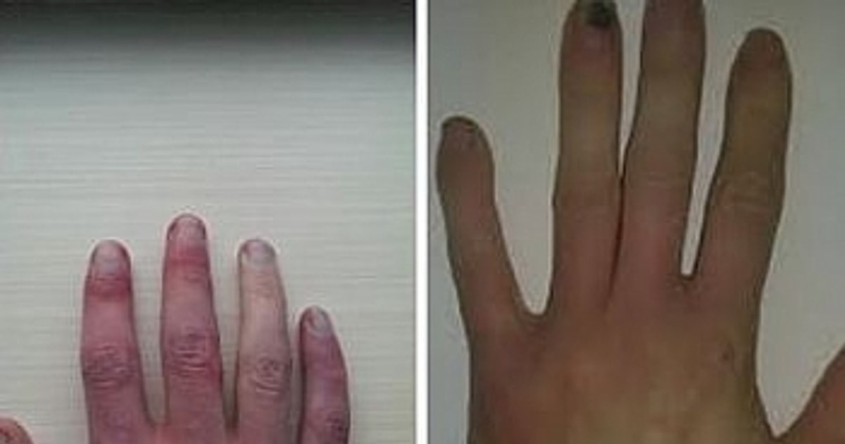 Hội chứng Raynaud